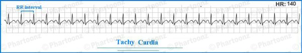 How to Read ECG basic common Charts - Phartoonz