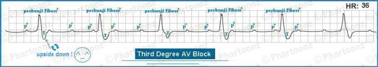 How to Read ECG basic common Charts - Phartoonz
