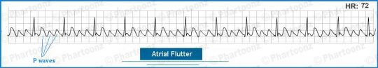 How to Read ECG basic common Charts - Phartoonz