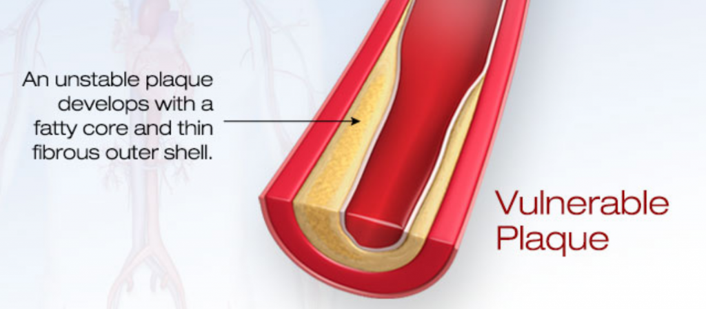 Plaque (Atherosclerosis) - How to remember - Phartoonz